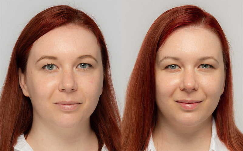 Real Skin, Real Results — Puffiness - Meder Beauty International