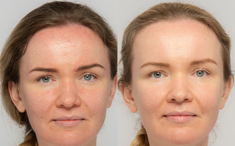 Real Skin, Real Results — Redness, Spots - Meder USA