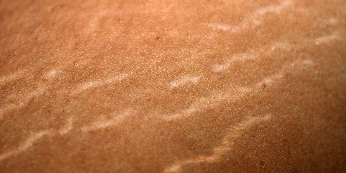 The Mystery of Stretch Marks - Meder Beauty International